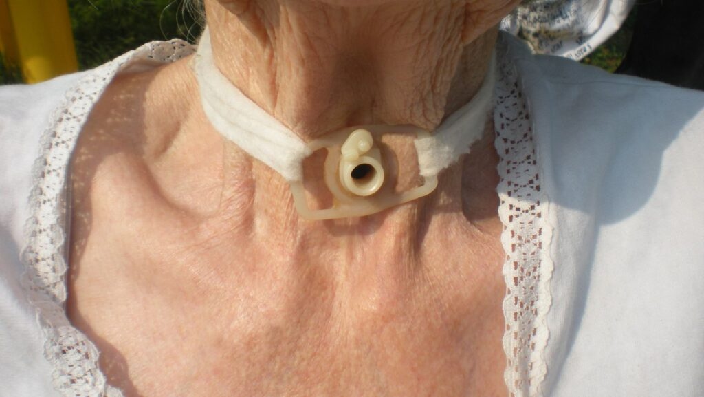 Tracheostomy care at home - Caring for tracheostomy - Aspire UK